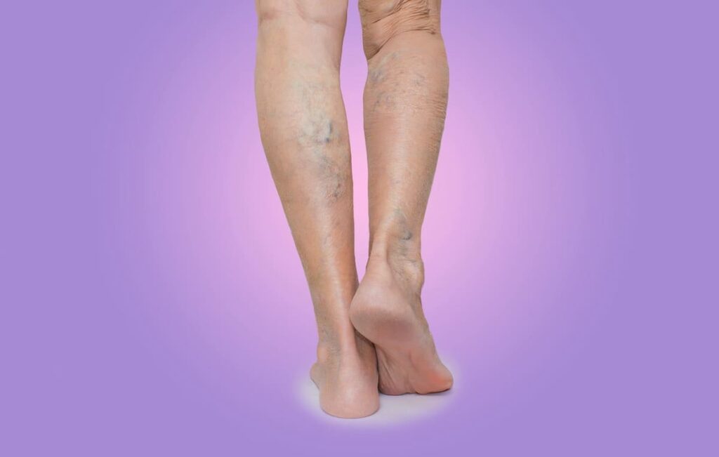 Blood and Vein circulation in the Legs and Feet - Global Vein