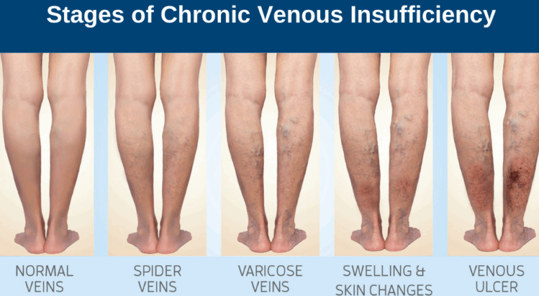 What exactly is CVI (chronic venous insufficiency)